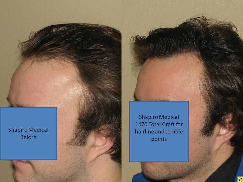 Temple Points | Hair loss Forum - Hair Transplant forums