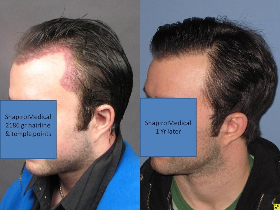 Temple Points | Hair loss Forum - Hair Transplant forums
